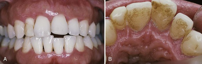 Carranza's Clinical Periodontology