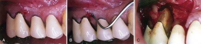 Carranza's Clinical Periodontology