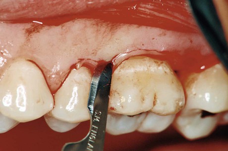Carranza's Clinical Periodontology