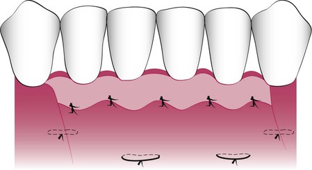 Carranza's Clinical Periodontology