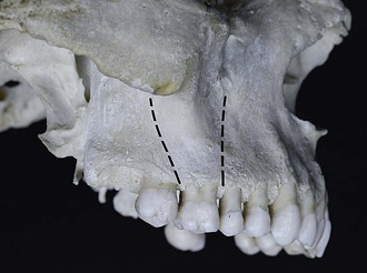 Molar and Incisor Positioning to Achieve Occlusal and Esthetic Objectives