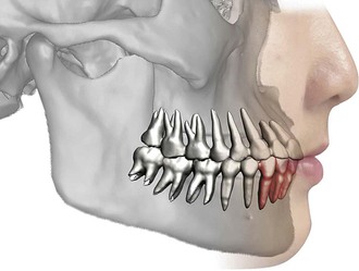 Molar and Incisor Positioning to Achieve Occlusal and Esthetic Objectives