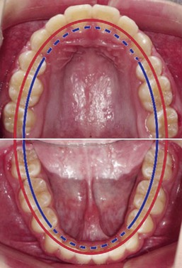 Molar and Incisor Positioning to Achieve Occlusal and Esthetic Objectives