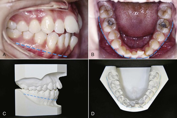 Molar and Incisor Positioning to Achieve Occlusal and Esthetic Objectives