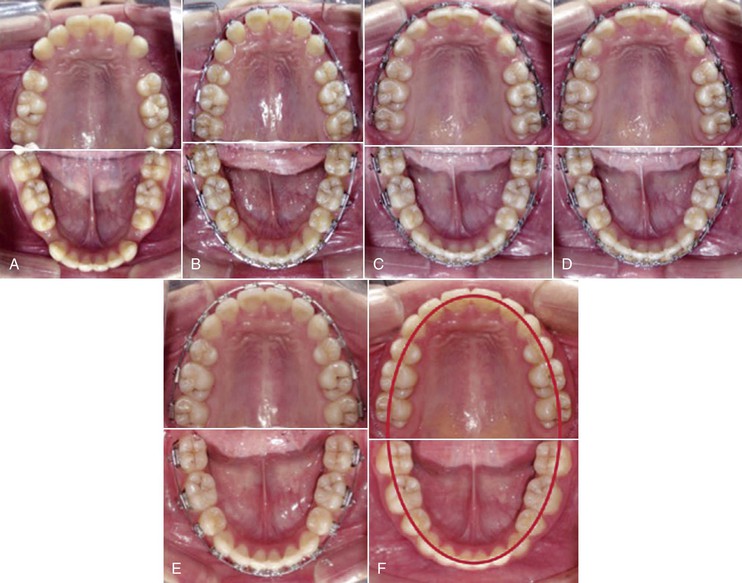 Molar and Incisor Positioning to Achieve Occlusal and Esthetic Objectives