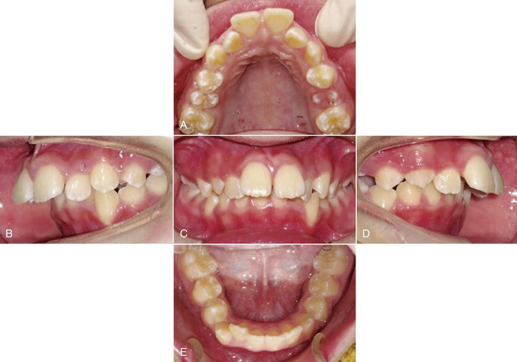 Molar and Incisor Positioning to Achieve Occlusal and Esthetic Objectives