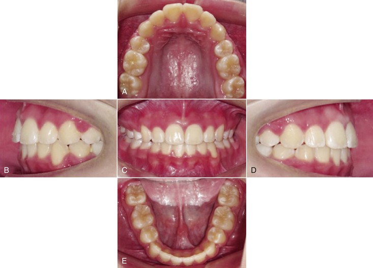 Molar and Incisor Positioning to Achieve Occlusal and Esthetic Objectives