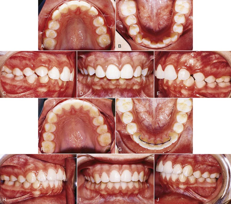 Nonextraction Class II Correction