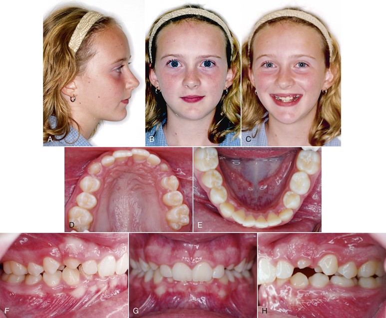 Class II Correction with an Intermaxillary Fixed Noncompliance Device