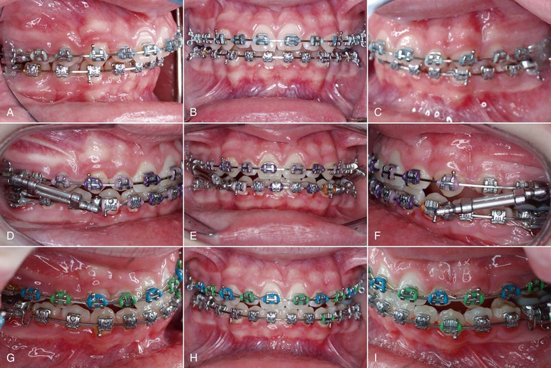 Class II Correction with an Intermaxillary Fixed Noncompliance Device