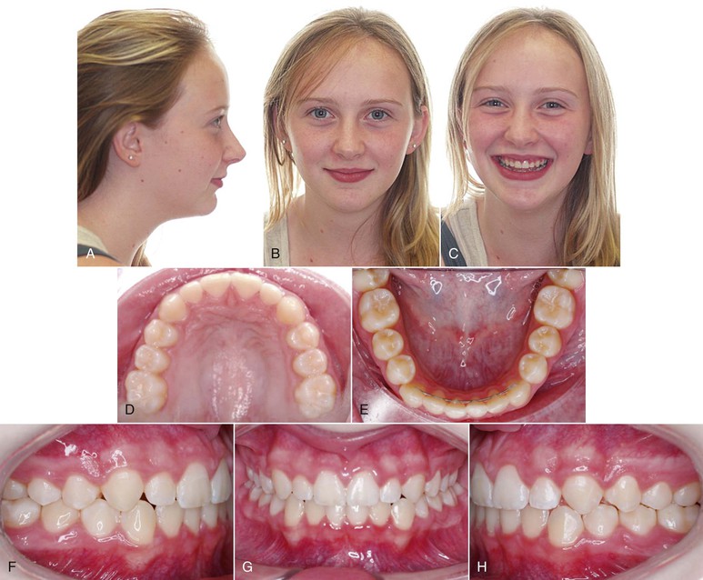 Class II Correction with an Intermaxillary Fixed Noncompliance Device