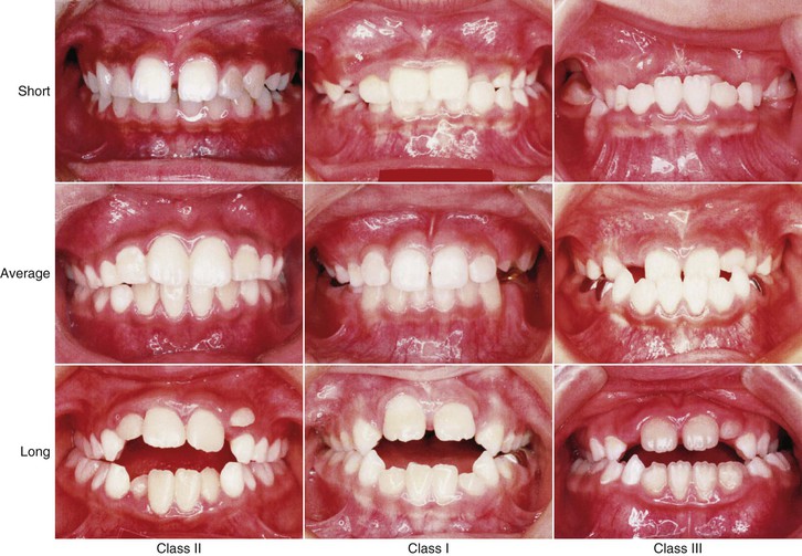 Clinical Practice Guidelines for Developing Class III Malocclusion