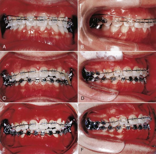 Clinical Practice Guidelines for Developing Class III Malocclusion