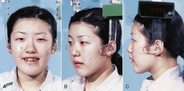 A Bioefficient Skeletal Anchorage System