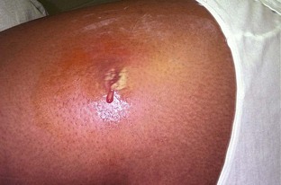 Asepsis and Infection Control