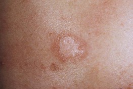Care of the Patient With an Integumentary Disorder