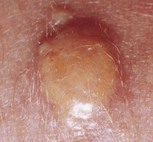 Care of the Patient With an Integumentary Disorder