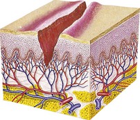 Care of the Patient With an Integumentary Disorder