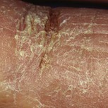 Care of the Patient With an Integumentary Disorder