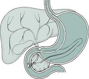 Care of the Patient With a Gallbladder, Liver, Biliary Tract, or ...