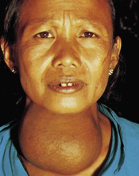 Care of the Patient With an Endocrine Disorder