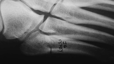 Commonly Encountered Fractures in Sports Medicine