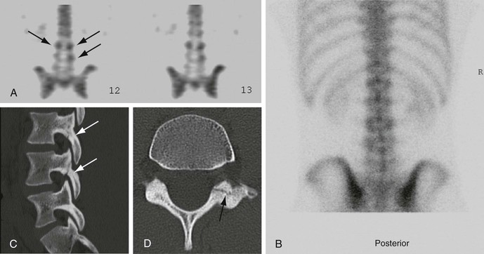 Commonly Encountered Fractures in Sports Medicine