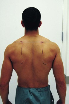 Scapulothoracic Disorders