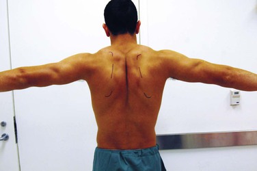 Scapulothoracic Disorders