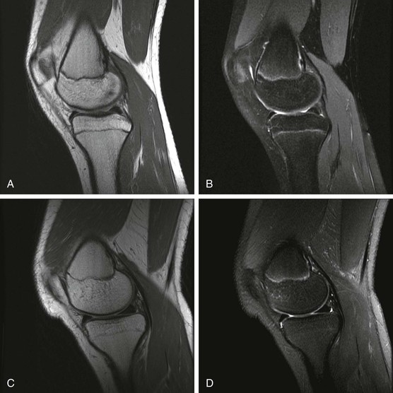 Imaging Considerations in the Skeletally Immature Patient