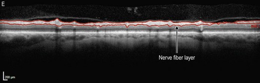 Handbook of Retinal OCT: Optical Coherence Tomography
