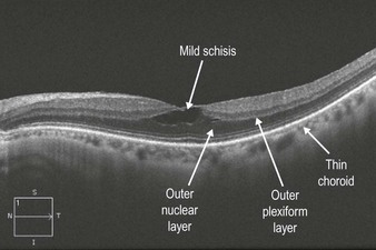 Handbook of Retinal OCT: Optical Coherence Tomography