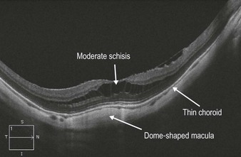 Handbook of Retinal OCT: Optical Coherence Tomography