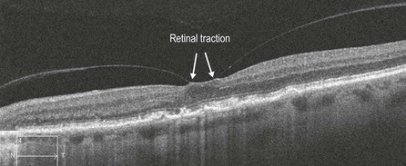 Handbook of Retinal OCT: Optical Coherence Tomography