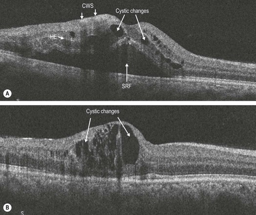 Handbook of Retinal OCT: Optical Coherence Tomography
