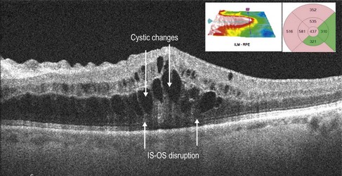 Handbook of Retinal OCT: Optical Coherence Tomography