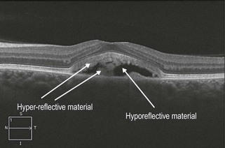 Handbook of Retinal OCT: Optical Coherence Tomography
