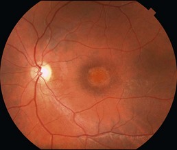 Handbook of Retinal OCT: Optical Coherence Tomography