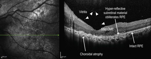 Handbook of Retinal OCT: Optical Coherence Tomography