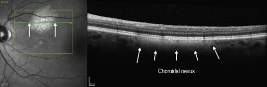 Handbook of Retinal OCT: Optical Coherence Tomography