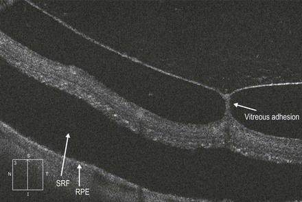 Handbook of Retinal OCT: Optical Coherence Tomography