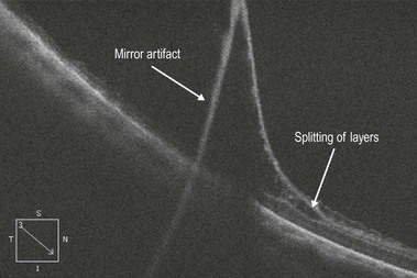 Handbook of Retinal OCT: Optical Coherence Tomography