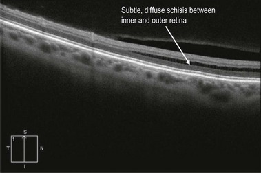 Handbook of Retinal OCT: Optical Coherence Tomography