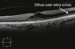 Handbook of Retinal OCT: Optical Coherence Tomography