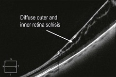 Handbook of Retinal OCT: Optical Coherence Tomography