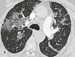 Airspace Diseases