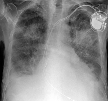 Airspace Diseases