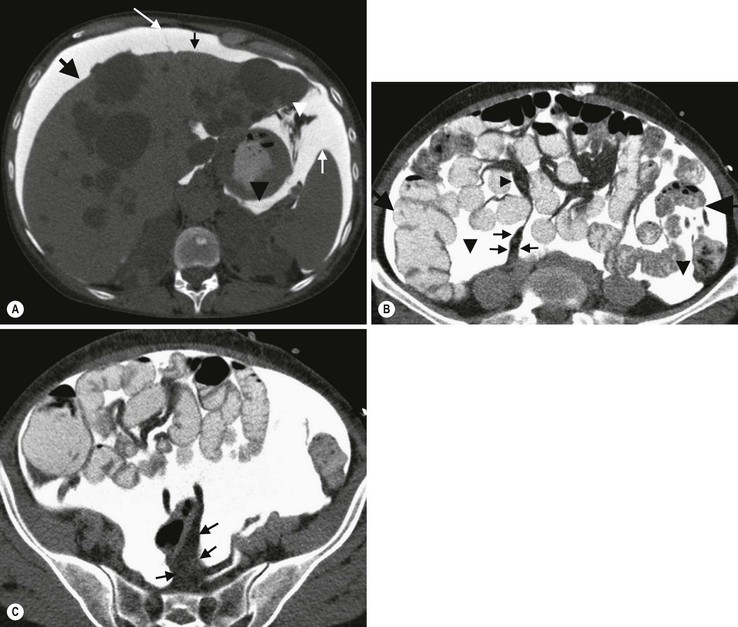 Imaging of The Peritoneum, Mesentery and Omentum