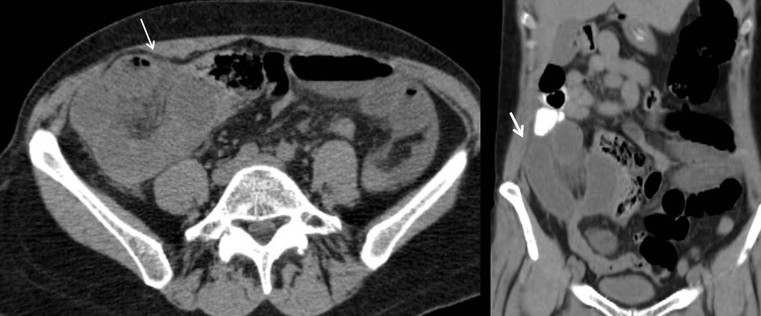 Imaging of The Peritoneum, Mesentery and Omentum