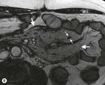 Imaging of The Peritoneum, Mesentery and Omentum